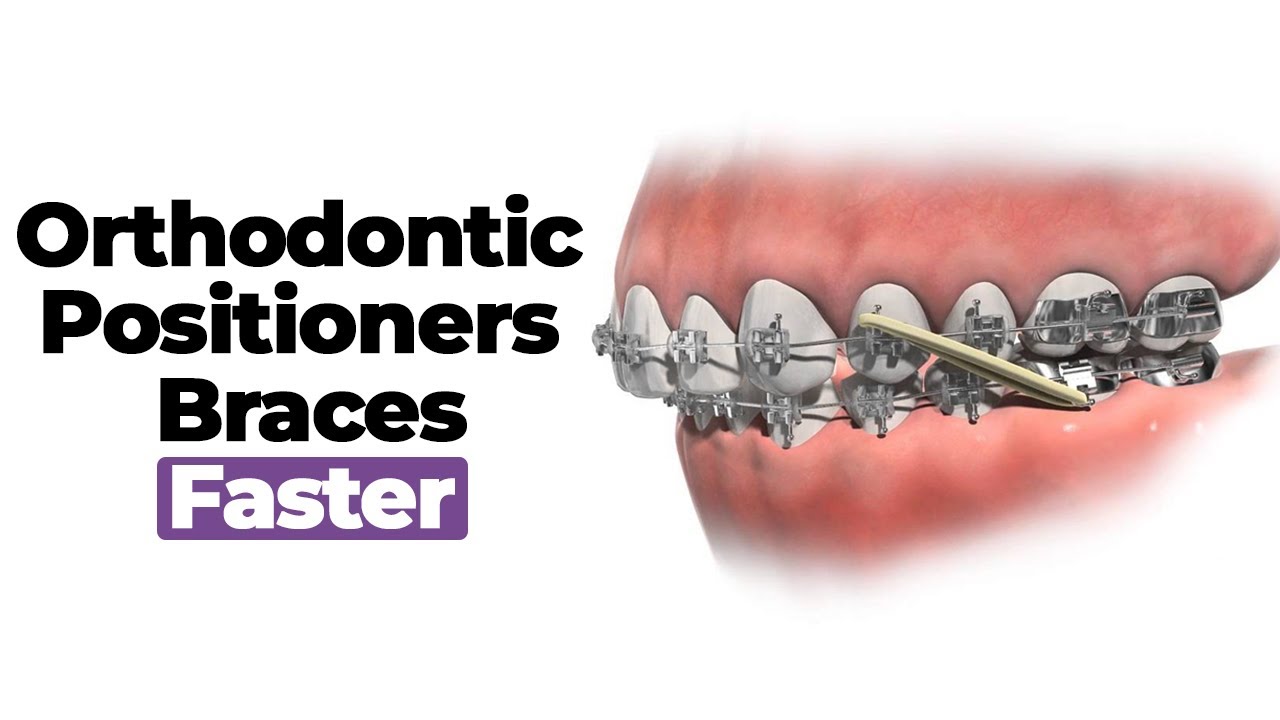 Orthodontic Positioners Braces Faster https://www.straightsmilesolutions.com/