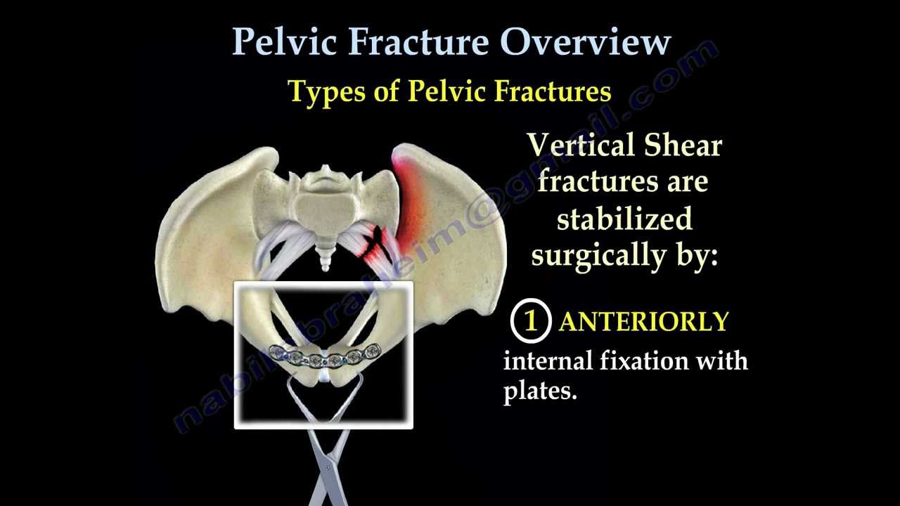Pelvic Fracture Overview - Everything You Need To Know - Dr. Nabil Ebraheim