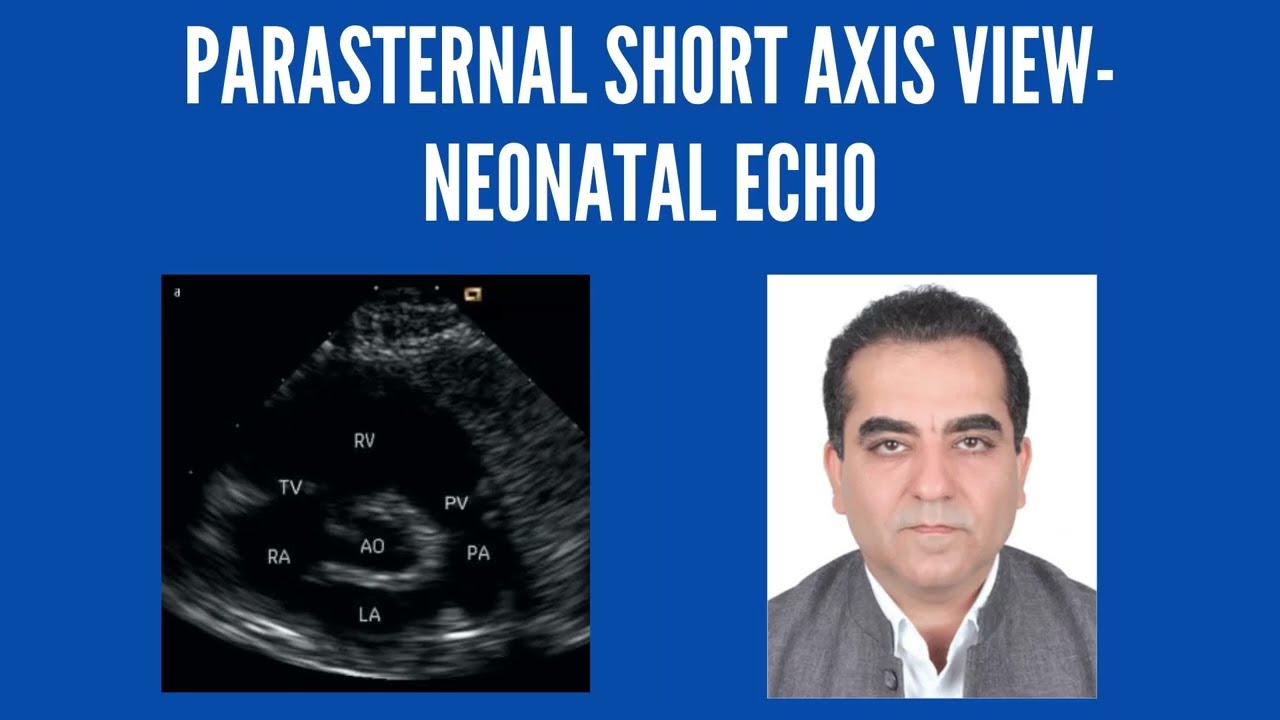 Neonatal echo l Parasternal short axis view #pocus #echo