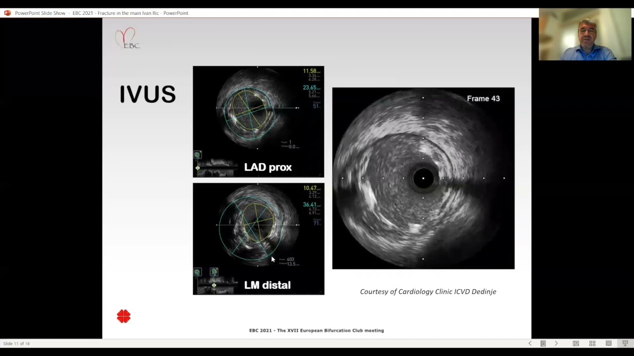 Fractured Stent in Left Main - Dr Ivan Ilic