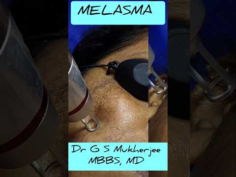Laser treatment for Melasma || Hyperpigmentation || Lentigens || Nd Yag pico laser || #drgsmukherjee