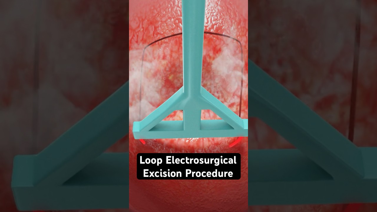 Cutting abnormal tissue from your cervix (3D Animation)
