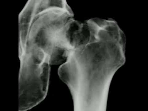 Right femoral neck fracture