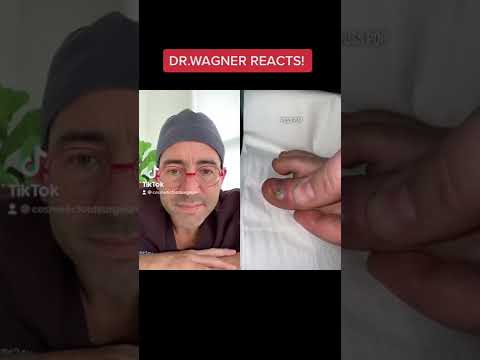 DRAINAGE OF PUS-FILLED PIMPLE😬#shorts #pimple #comedy #cyst