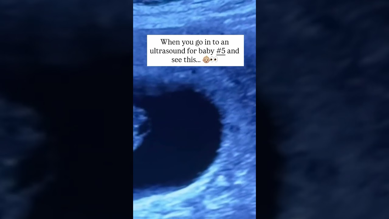 When you go into an ultrasound for baby #5 and see this…
