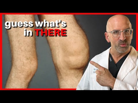 SWOLLEN Joint - What's in there? 💦 #shorts