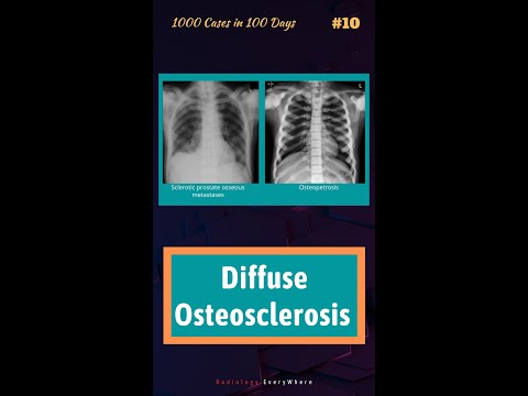 Causes for Diffuse Osteosclerosis | Radiology tutorials | 1000 cases in 100 days | video-10
