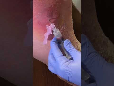 DRAINING A LEG HEMATOMA! #shorts #hematoma