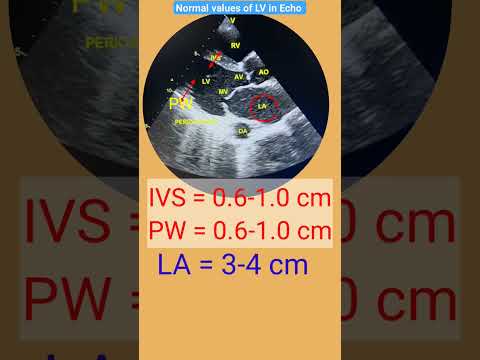 Normal values of IVS, LA, LV size in Echo l #echo #shorts