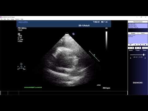 aortic dissection in marfans syndrome