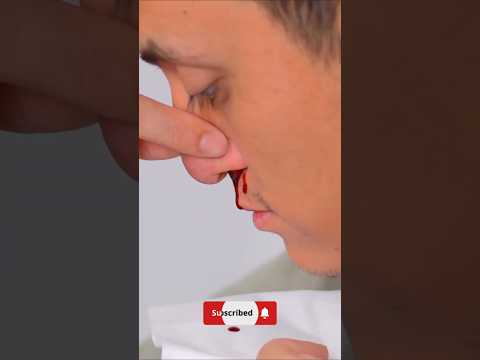 Nose bleed | Epistaxis | Epistaxis treatment