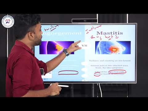 Breast Engorgement VS Mastitis | OBG | By Sirisetti Prasad Sir | RNI