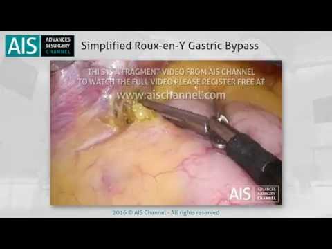 Simplified Roux-en-Y Gastric Bypass