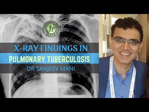 PULMONARY TUBERCULOSIS - X-RAY FINDINGS | DR SANJEEV MANI | MILIARY MOTTLING | ROLE OF IMAGING IN TB