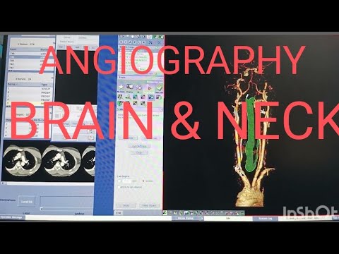 ct angiogram head and neck with contrast | CT ANGIO Brain and Neck