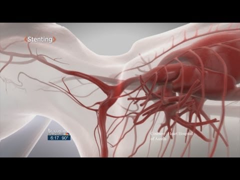 Austin surgeons study new method of carotid artery treatment