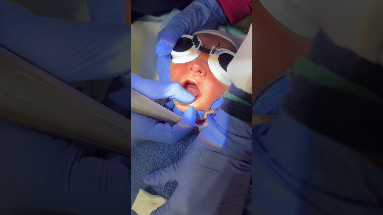 Tongue tie release procedure- helping newborns feed better ❤️#newborn #postpartum #breastfeeding