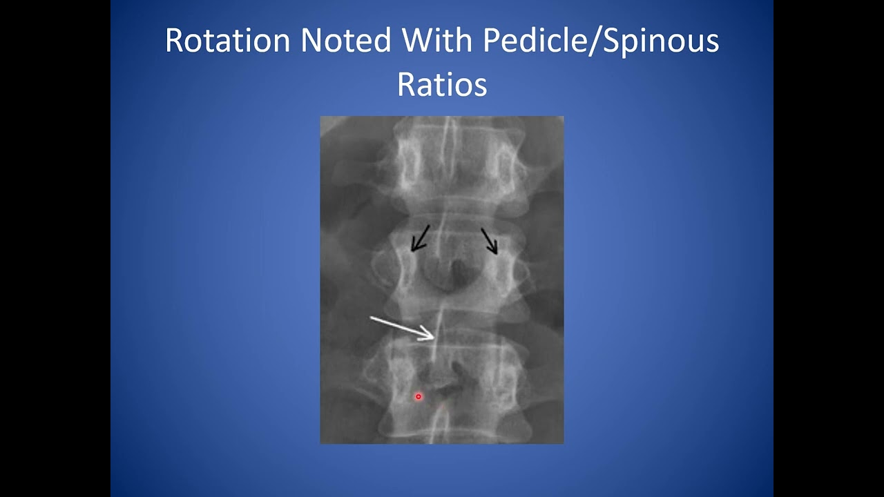 How to Read a Lumbar Spine X-ray | Reading Standing Spine X-ray
