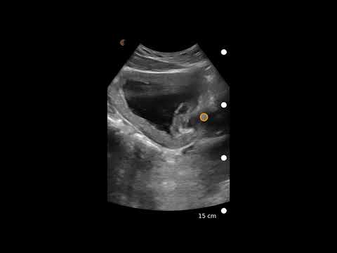 Bladder Debris: Ultrasound Image Interpretation