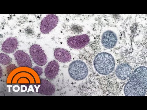 California, Illinois Declare Monkeypox Health Emergencies