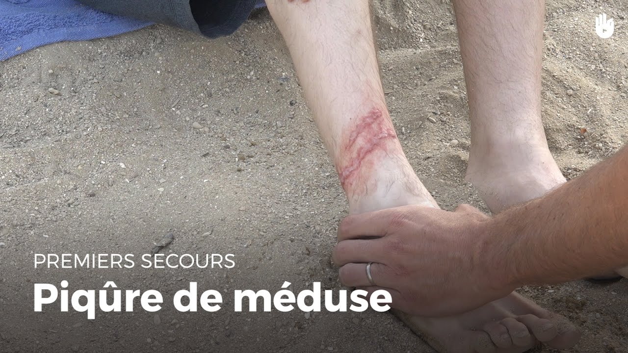 Premiers secours : Piqure de méduse - Les gestes de premier secours ...