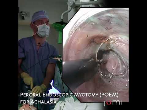 Peroral Endoscopic Myotomy (POEM) for Achalasia