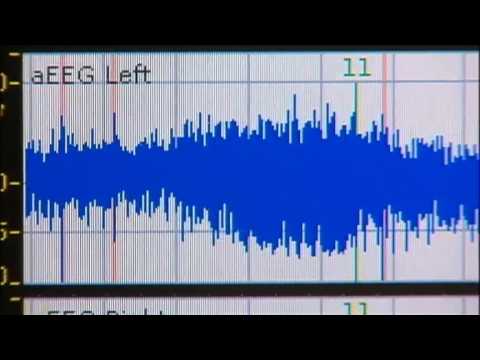New Techniques Prevent Infant Brain Damage