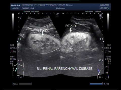 Bilateral Renal Parenchymal Disease, Two videos.