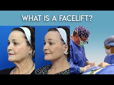What is a Facelift?