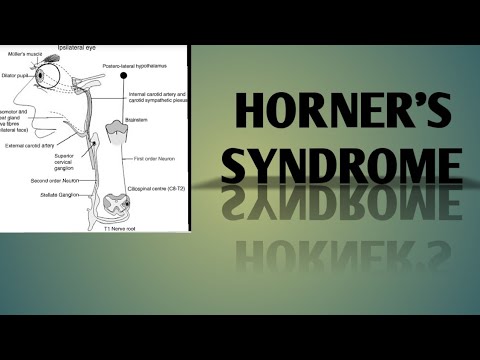 Horner's Syndrome easy explanation
