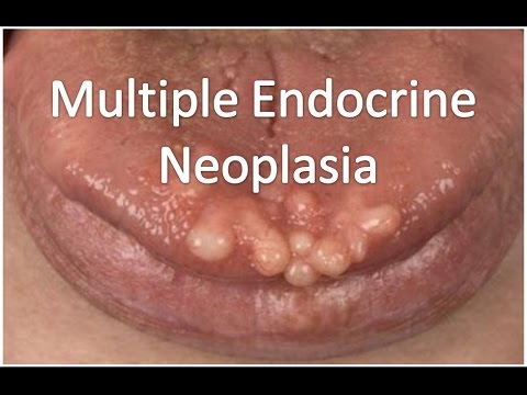 Multiple Endocrine Neoplasia (MEN 2B)