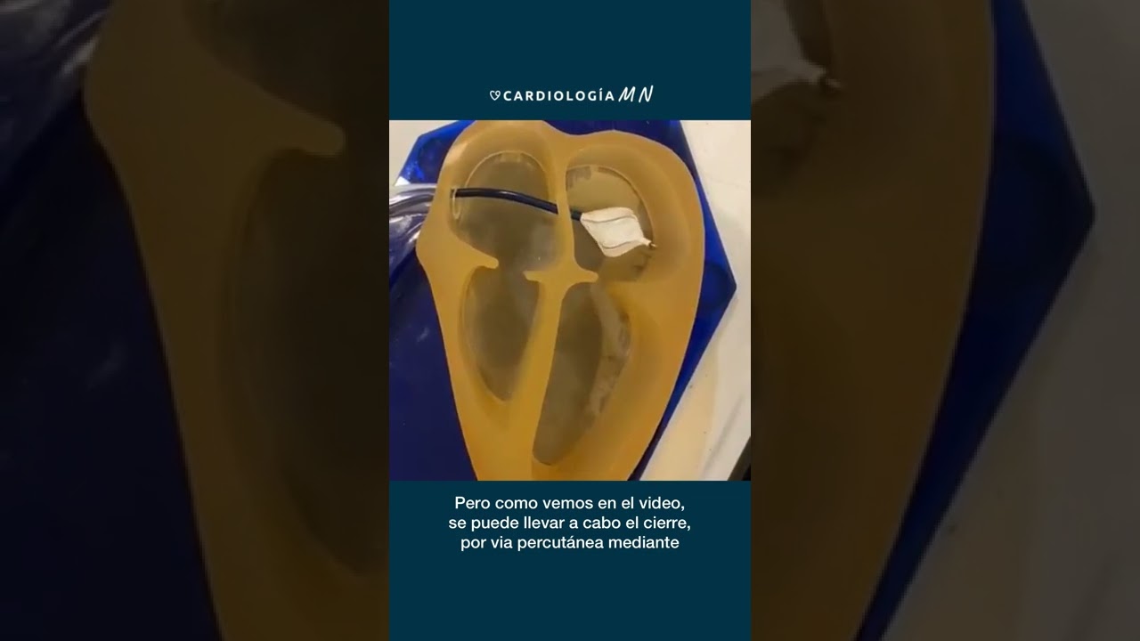 Atrial septal defect (ASD)