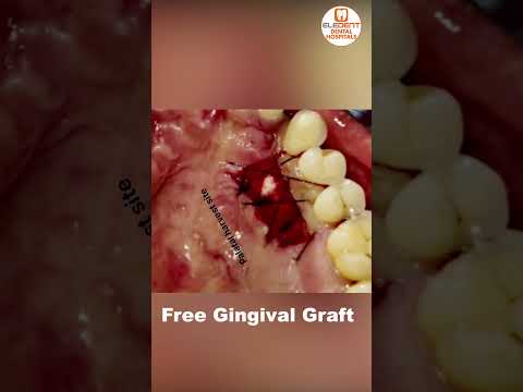 Resolving Gum Recession With Free Gingival Graft | Best Dental Hospital In India | Eledent Hospitals