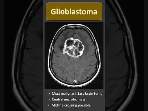 the most frequent brain tumors in adults #radiology #neuro #brain #braintumors #medicalstudent