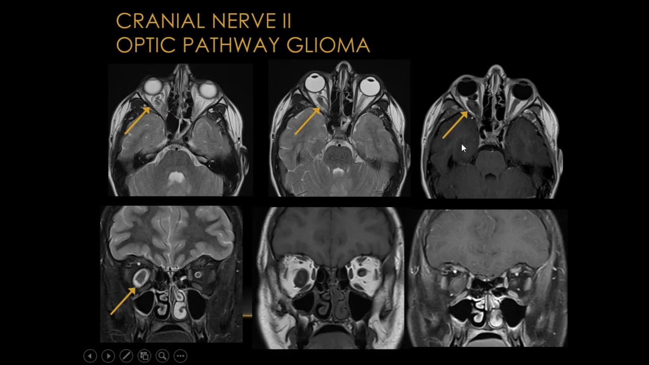 Cranial Nerves MRI Diagnostics - Part 1 - [Basic Radiology]