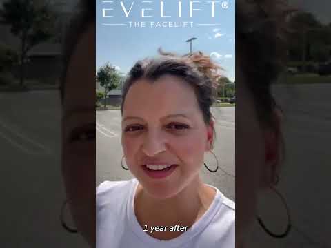 Patient Testimonial One Year After EVE Lift™ | Eden Plastic Surgery: Dr. Ali Charafeddine, MD