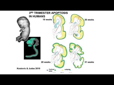 CARTA: Human Origins: Lessons from Autism Spectrum Disorders - Eric Courchesne