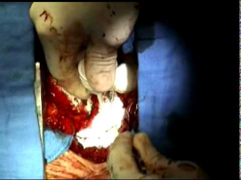 LVAD Procedure