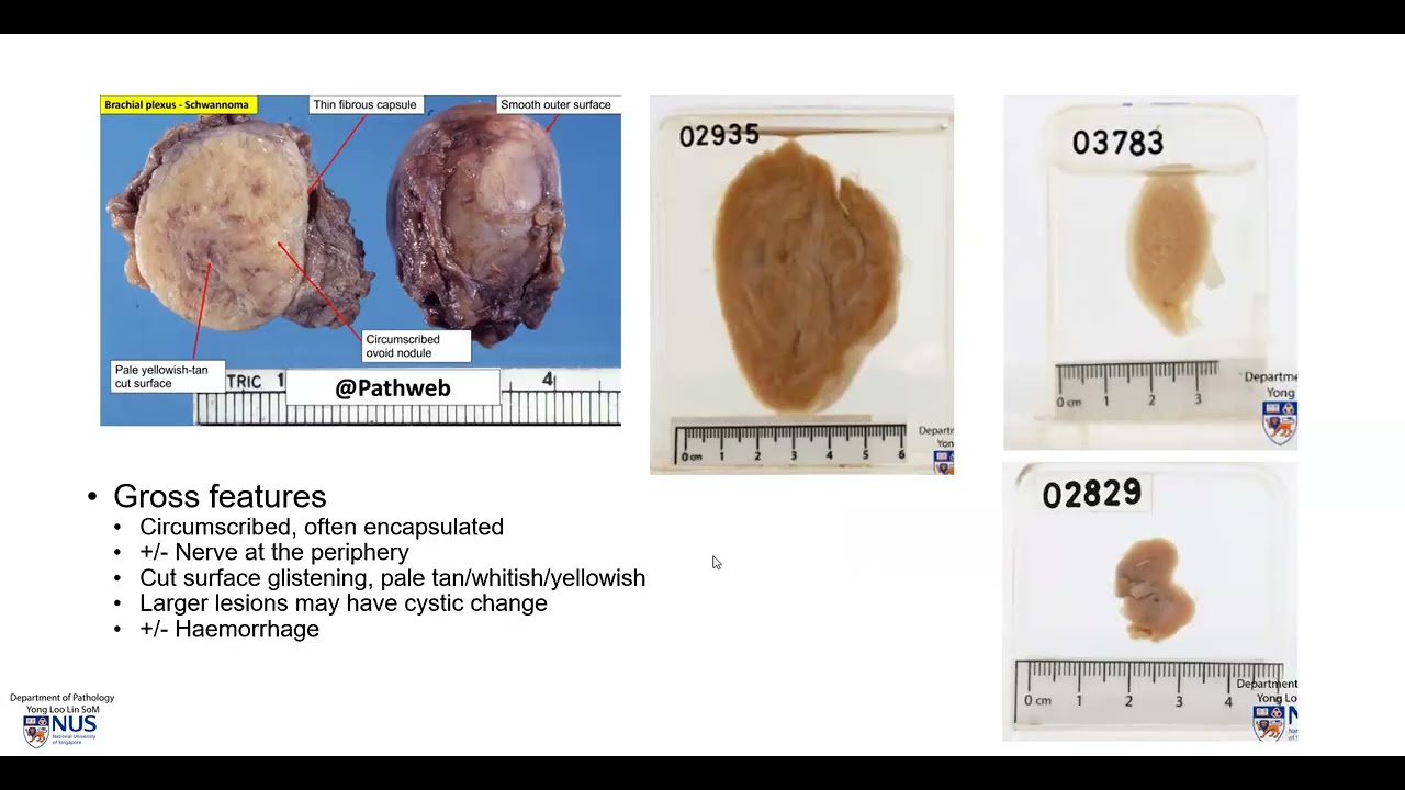 Nerve - Schwannoma (Gross pathology)