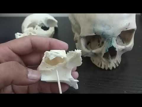 Paranasal Sinuses