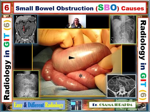 6 SBO causes update