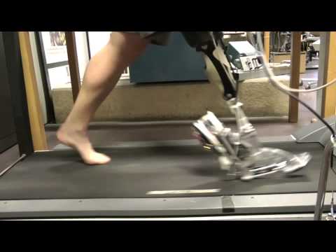 Prosthetic Foot And Ankle Have Amazingly Natural Movement | Hackaday