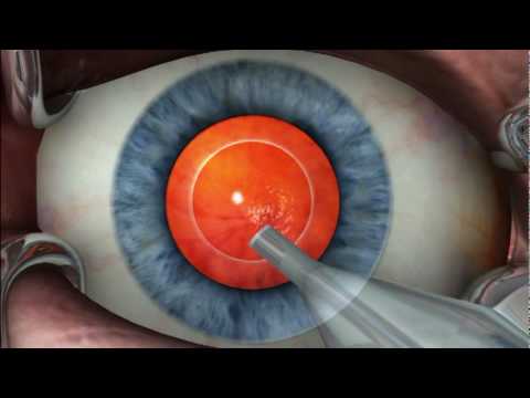 Opération cataracte laser, chirurgie cataracte, implant cataracte ...
