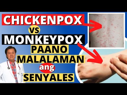 Chickenpox VS Monkeypox: Paano Malalaman sa Senyales - Payo ni Doc Willie Ong #1387