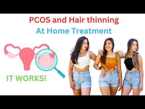PCOS and Hair Loss: The Link and Treatment (At Home, but requires Effort)