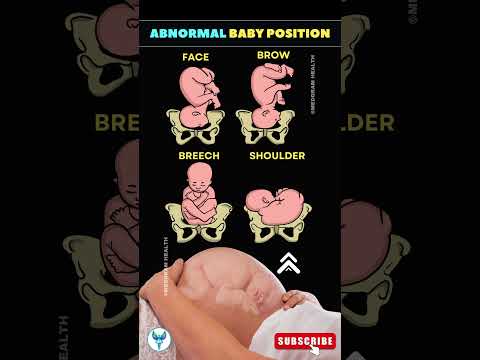 Abnormal Baby Position Inside Womb | Understanding Fetal Positions #Pregnancy #Baby