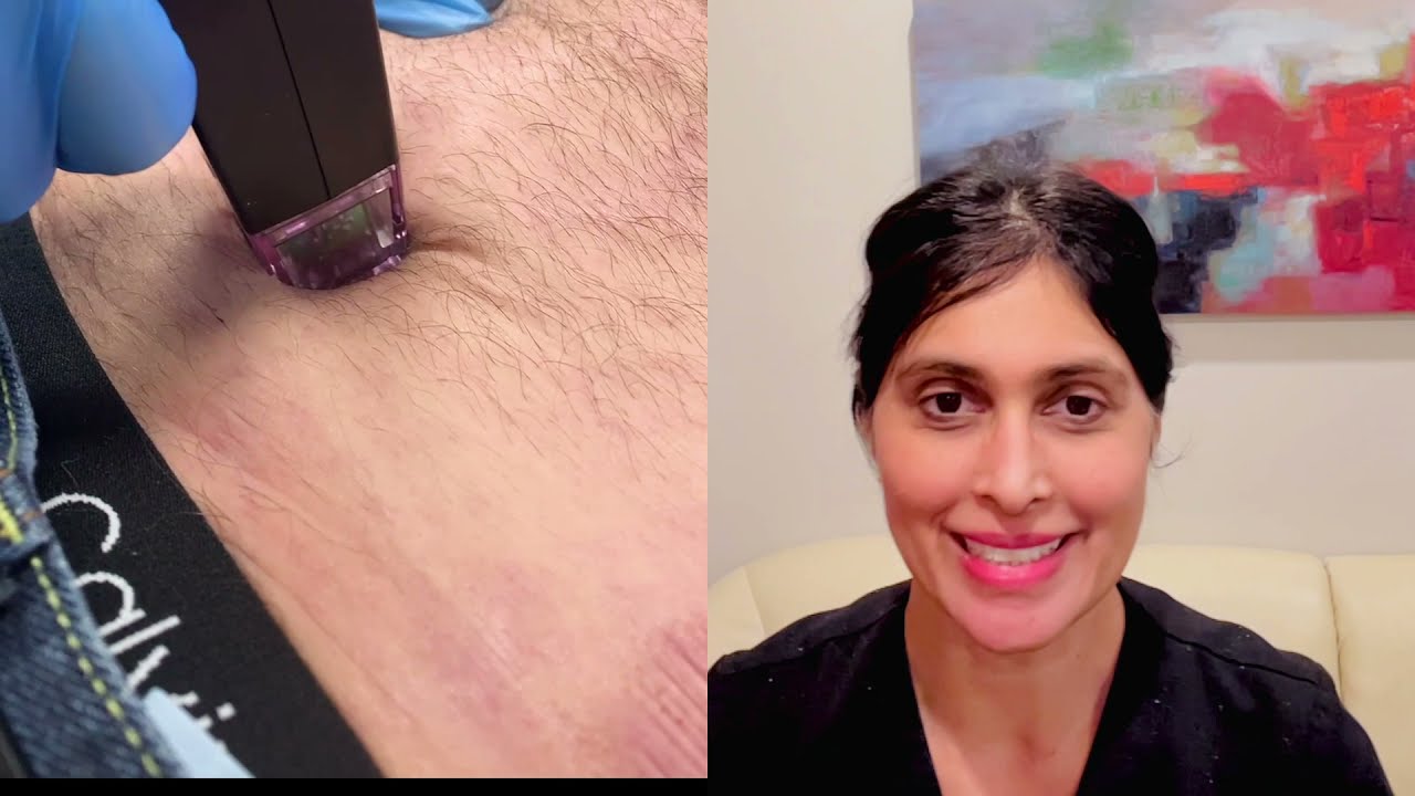 Morpheus8 for Body Skin Tightening