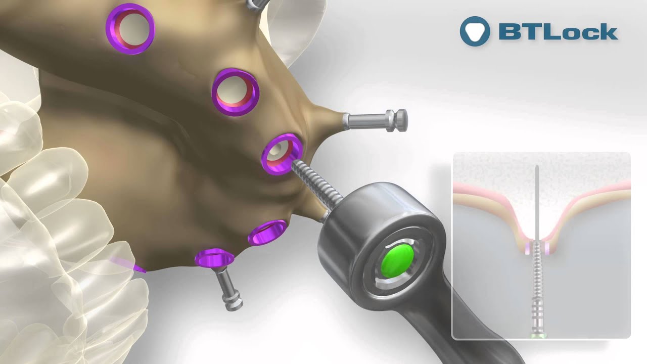 Btlock: Guided Surgery - expanders technique
