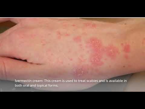 Top 10 Prescription Creams for Scabies Treatment