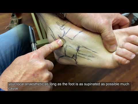 Topographical Anatomy of the Foot and Ankle  Lateral Aspect and Nerves of the Foot and Ankle